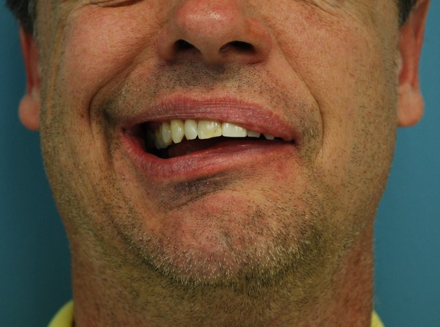 Pre-Surgery for Cross Face Never Graft - Gracilis - Photo